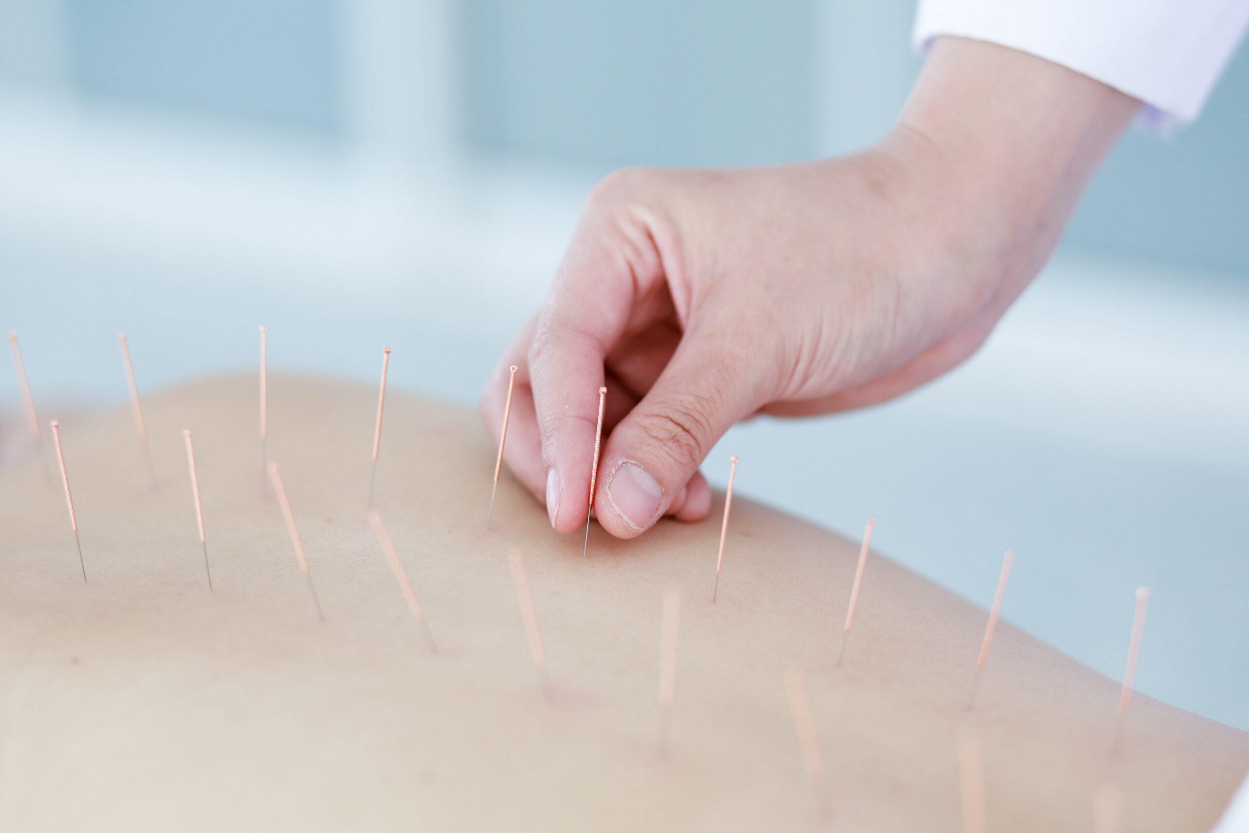 Acupuncture - Ontario Manual Physio